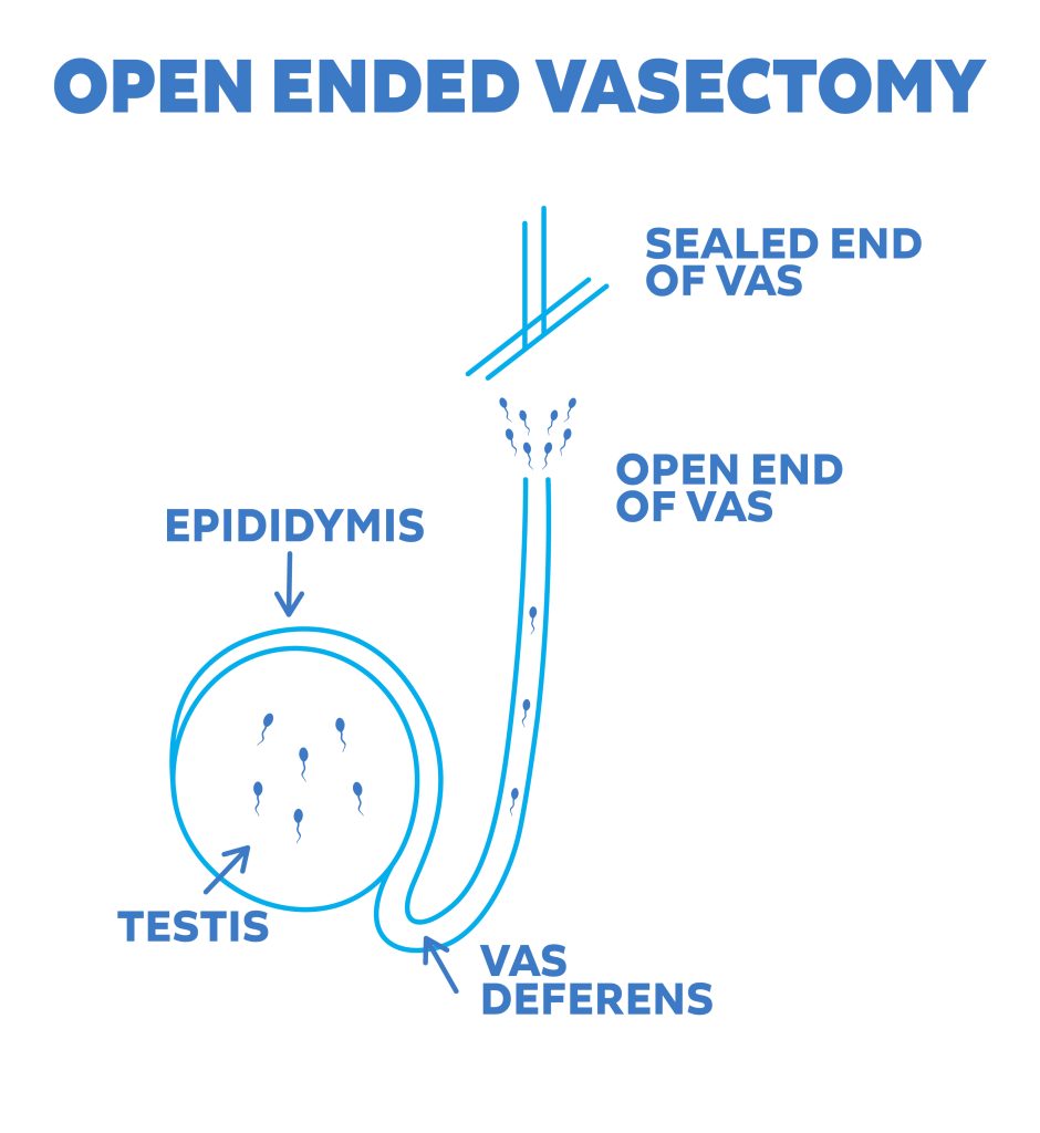 Vasectomy Procedure | What to Expect & Aftercare Instructions
